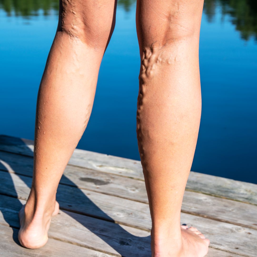 Frequently Asked ions About Peripheral Artery Disease 